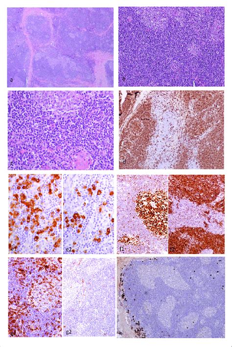 Histopathological Findings Of Patient 2 The Right Orbital Mass