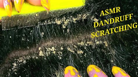 Asmr Dandruff Scratching Part 1 083 Youtube