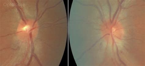 Blurred Disc Margins Ou Optocase