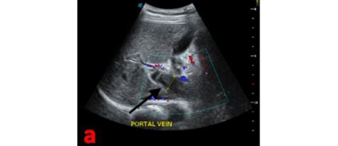 Vascular Disease Management On Linkedin Vdm Venous