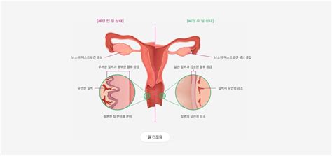 50대 폐경기 갱년기 여성을 괴롭히는 질건조증 효과적인 예방법과 치료법은
