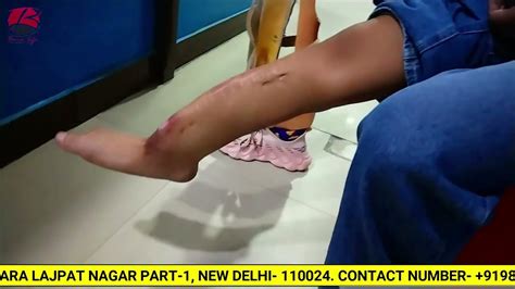 Reforming The Life Of Partial Foot Amputee With Hi Technology