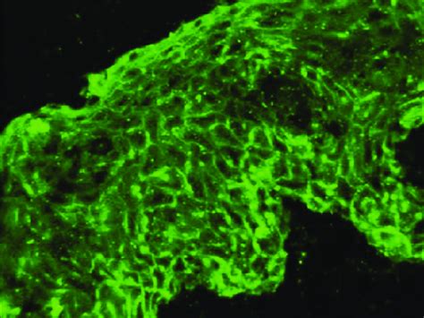 Direct Immunofluorescence Of Oral Epithelium Showing Characteristic