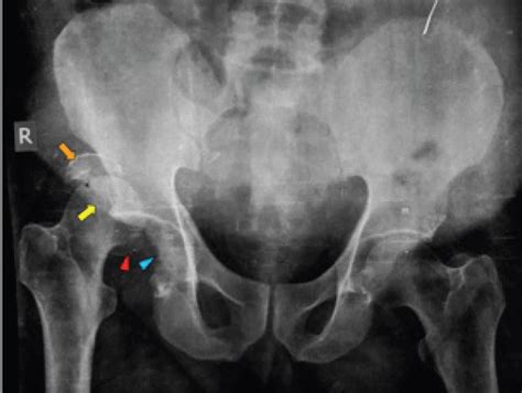 Neglected Two Week Old Unstable Fracture Dislocation Of The Hip In A 60