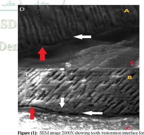 Table 3 From Effect Of Dentin Moisture And Bonding Strategies On Micro Tensile Bond Strength
