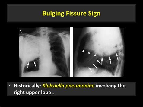 Figure 3 Sign Fleischner Sign Fissure Sign Headcheese Sign Hilar Over…