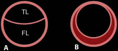 A Diagram Of Classic Aortic Dissection On The Left Illustrating A