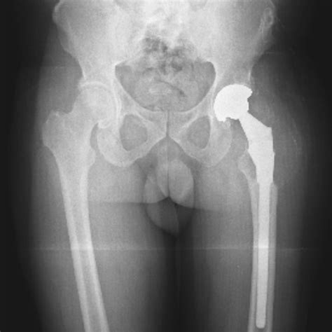 Proximal Left Femur Resection Followed By Reconstruction With A Modular