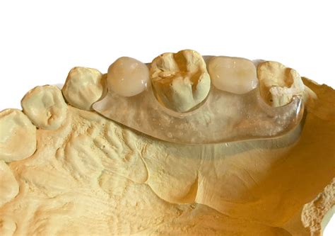 Flipper Nesbit Custom Fitted Missing Teeth Space Filler Cosmetic