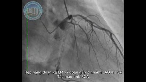 Lm Lad Lcx Rca Youtube
