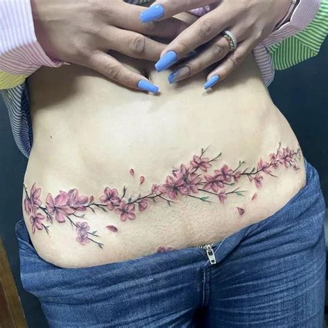 Tummy Tuck Tattoo What You Need To Know Sao Viet