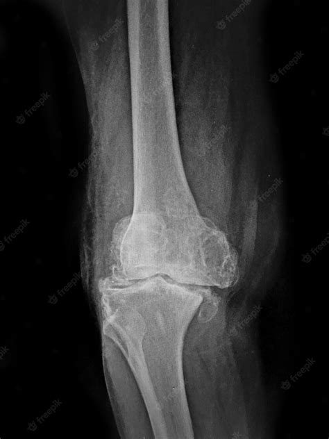 Premium Photo Osteoarthritis Knee Film Xray Ap Anterior Posterior