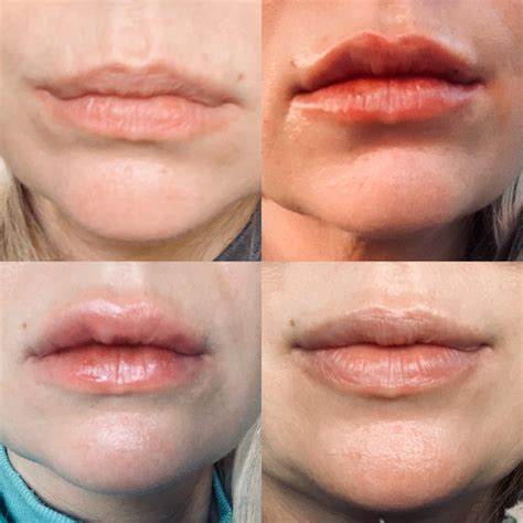 Juvederm Lip Filler Progress Top Left Beforetop Right Immediately