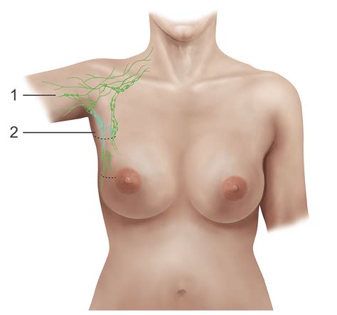 Sentinel Node Biopsy Healthdirect