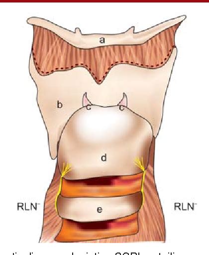 Partial Laryngectomy