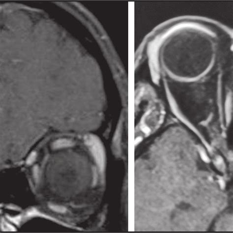 Fundus Showing Blurred Optic Disc Margins Suggestive Of Disc Edema Red