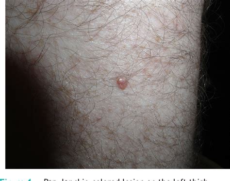 Figure 2 From An Amelanotic Dysplastic Melanocytic Nevus Induced By