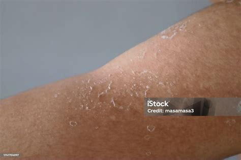 The Skin Of A Japanese Man Whose Skin Has Peeled Off Due To Sunburn
