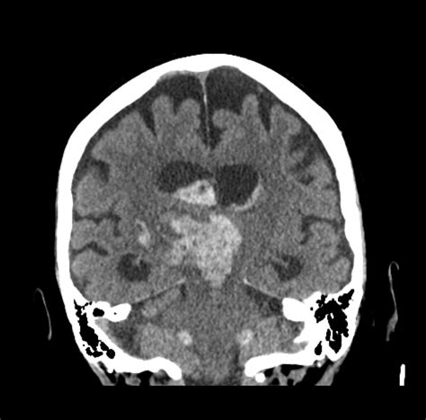 Iph And Ivh Scrolller