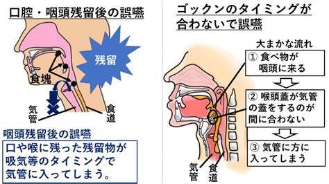 【簡単に解説】訪問看護・訪問リハビリで役立つ咽頭期の嚥下訓練 八尾市 にじリハ訪問看護ステーション