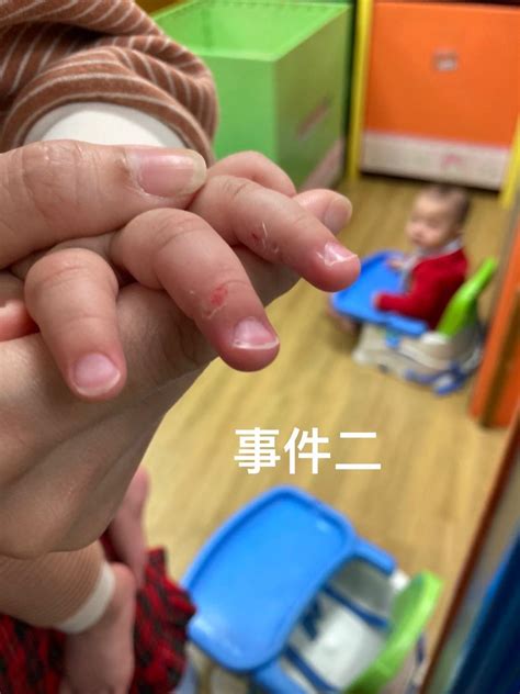 爆料公社 家長指控托嬰中心托育不當，遭同個老師弄傷兩次，主任竟回「道歉到很厭煩了」要求退托