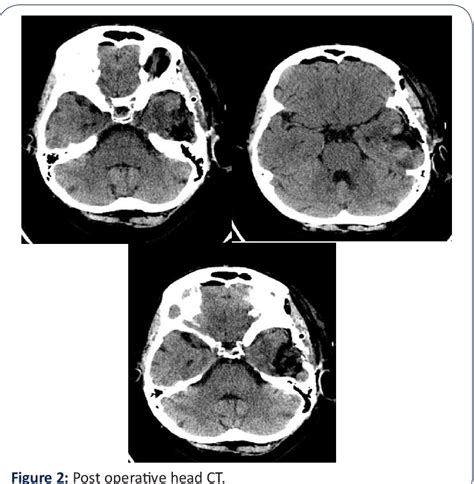Figure 1 From Metastatic High Grade Intimal Sarcoma Of The Middle Cranial Fossa Case Report