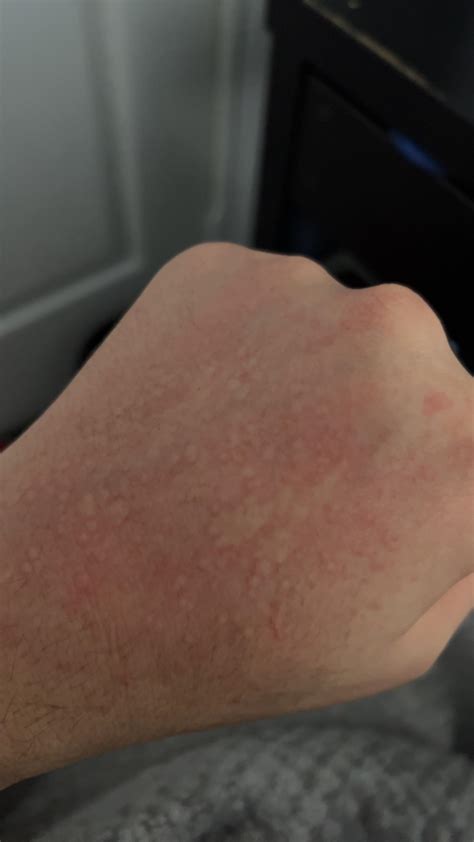 Hives Rallergy