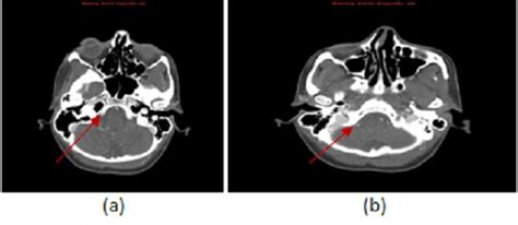 Vertebral Artery Dissection Cta Docneuro