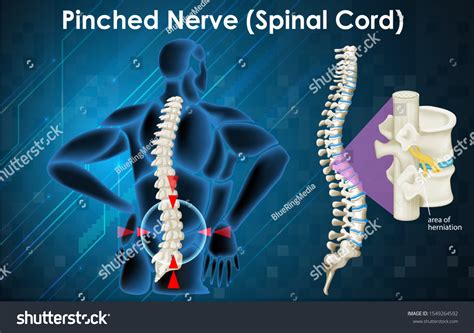 Diagram Showing Pinched Nerve Human Illustration Stock Vector Royalty