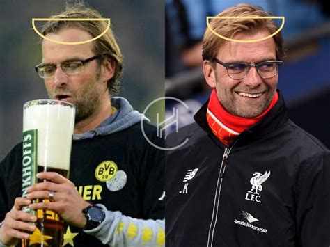 Jurgen Klopp Hair Transplant Hair Loss And Technical Analysis