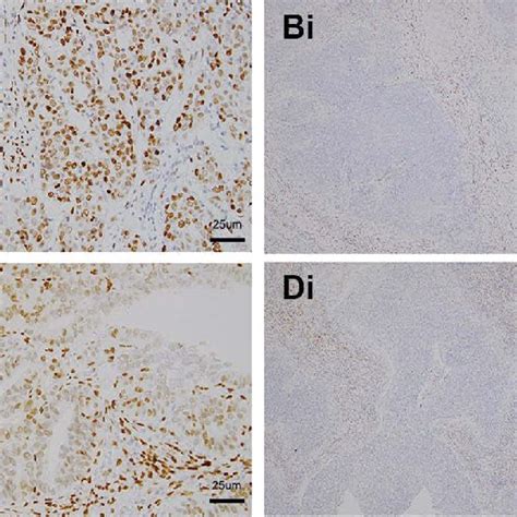 Immunohistochemical Staining Of ER And PR Expressions 1Ai 1Aii