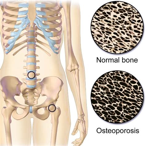 Osteoporosis Latest Facts Causes Diagnosis Complications Treatments
