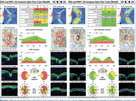 Figure 1 From Segmented Retinal Analysis In Pituitary Adenoma With Chiasmal Compression A