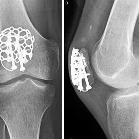 Robinsons Classification System For Midshaft Clavicular Fractures