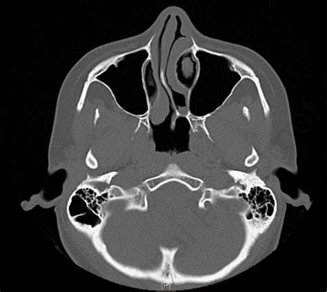 Ct Image Showing The Inflamed Left Inferior Turbinate Septal