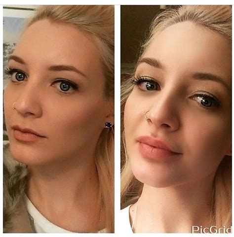 Botox Lips Before And After