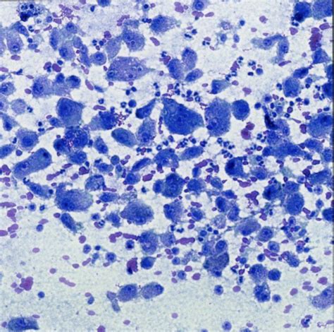 Primary Hepatic Malignancy Flashcards Quizlet