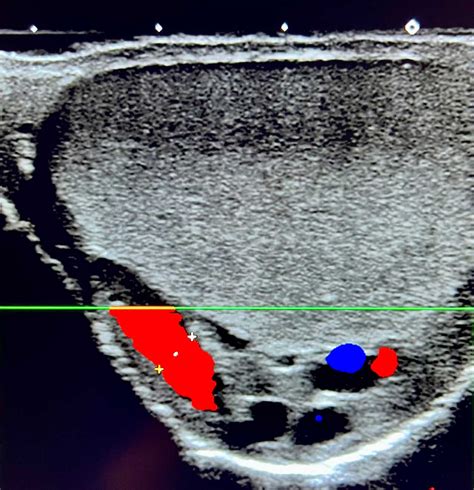 Varicocele Embolisation Pelvic Congestion Syndrome Dr Crowe