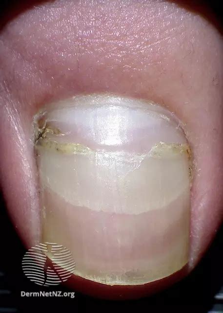 What Causes Horizontal Ridges In Fingernails