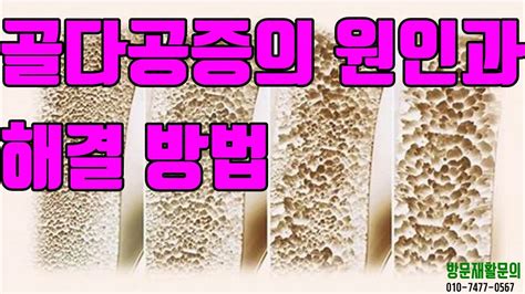 뼈에 구멍이 숭숭 도대체 왜 이런일이 생기는 걸까 청주방문재활운동센터 Youtube