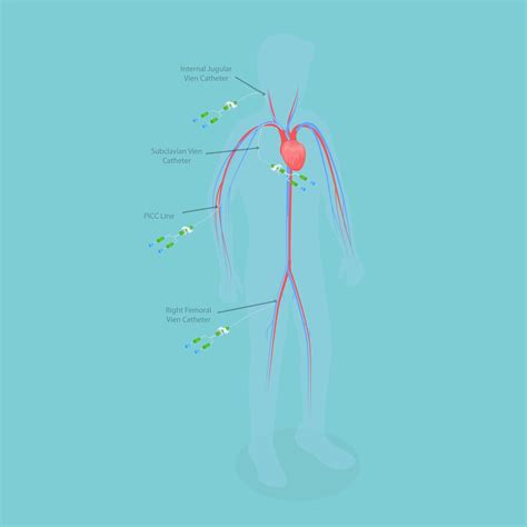 3d Isometric Flat Conceptual Illustration Of Picc Line Central Venous Catheter 58985007 Vector
