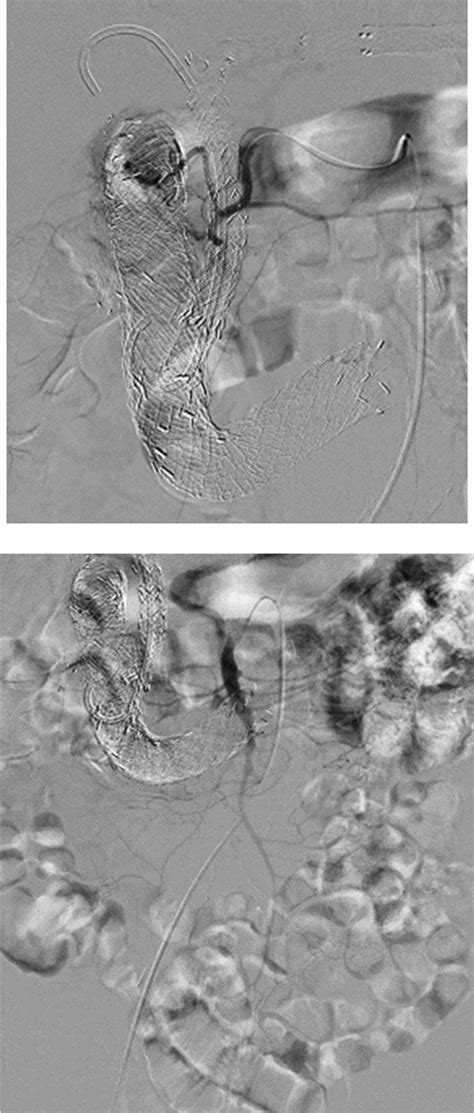 A Angiography Of The Gastroduodenal Artery Showing No Extravasation Download Scientific