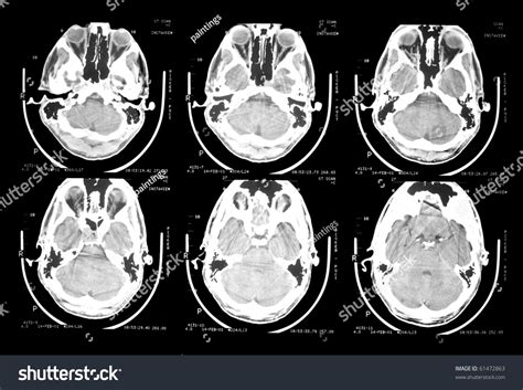 Ct Scan Of 30 Year Old Male Skull And Brain Imagen De Archivo Stock
