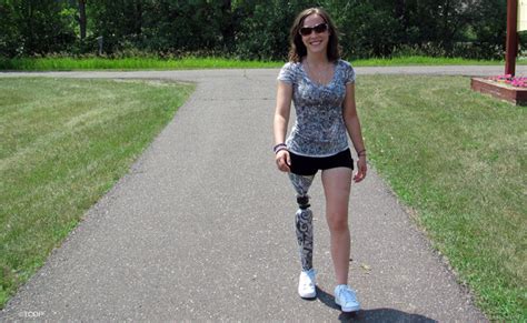 Double Above Knee Amputee