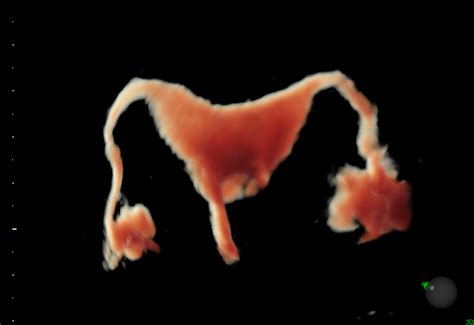 Tubal Patency Ultrasound Empowered Womens Health