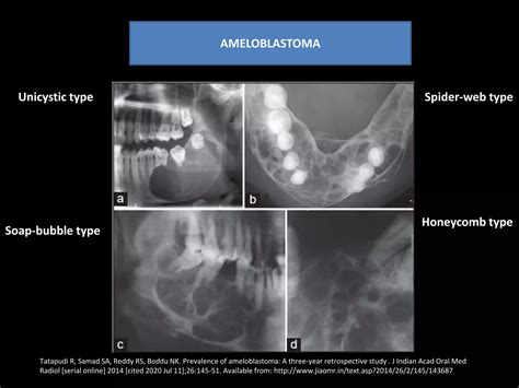 Central Giant Cell Granuloma From Diagnosis To Management Pptx