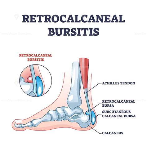Retrocalcaneal Bursitis As Ankle Achilles Tendon Bursa Outline Diagram