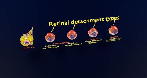 Retinal Detachment Types Eye 3d Model Superhive Formerly Blender Market
