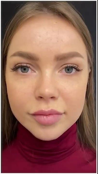 Прекрасный результат даже спустя 3 года после операции Youtube