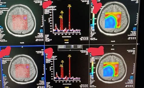 Waseem Zafar On Linkedin Multi Voxel Mr Spectroscopy Performed On